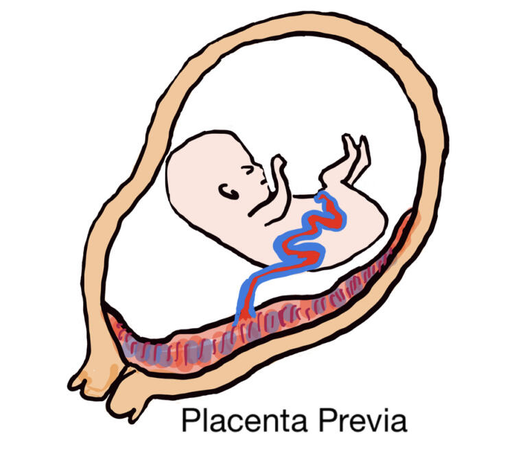 PLACENTA ANTERIOR - Salud Materno Infantil Sagunto